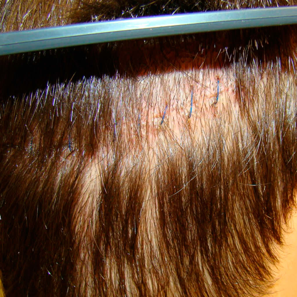Ryan's Full Hair Transplant Journal - Dr. Brett Bolton's Latest News