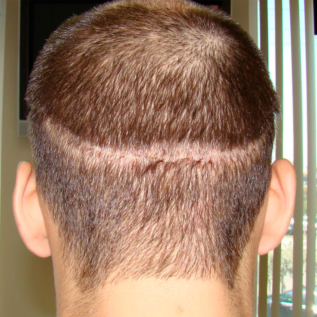 Ryan's Full Hair Transplant Journal - Dr. Brett Bolton's Latest News